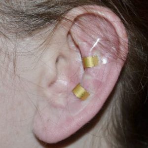 Ear Fold | Ear Reconstruction