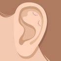 Ear Fold | Ear Reconstruction