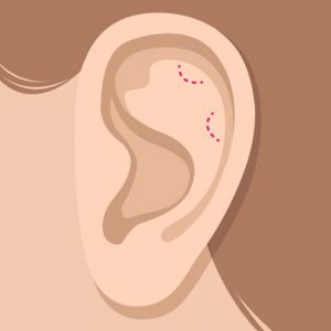 Ear Fold | Ear Reconstruction