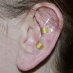 Ear Fold | Ear Reconstruction